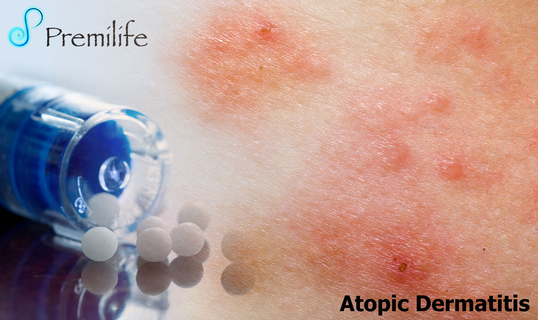 Atopic Dermatitis | Premilife - Homeopathic Remedies