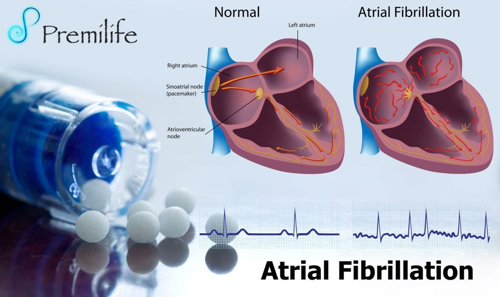 Atrial Fibrillation | Premilife - Homeopathic Remedies