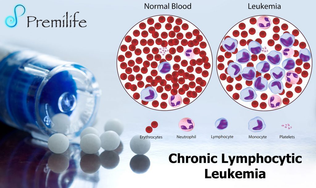 Chronic Lymphocytic Leukemia Cells