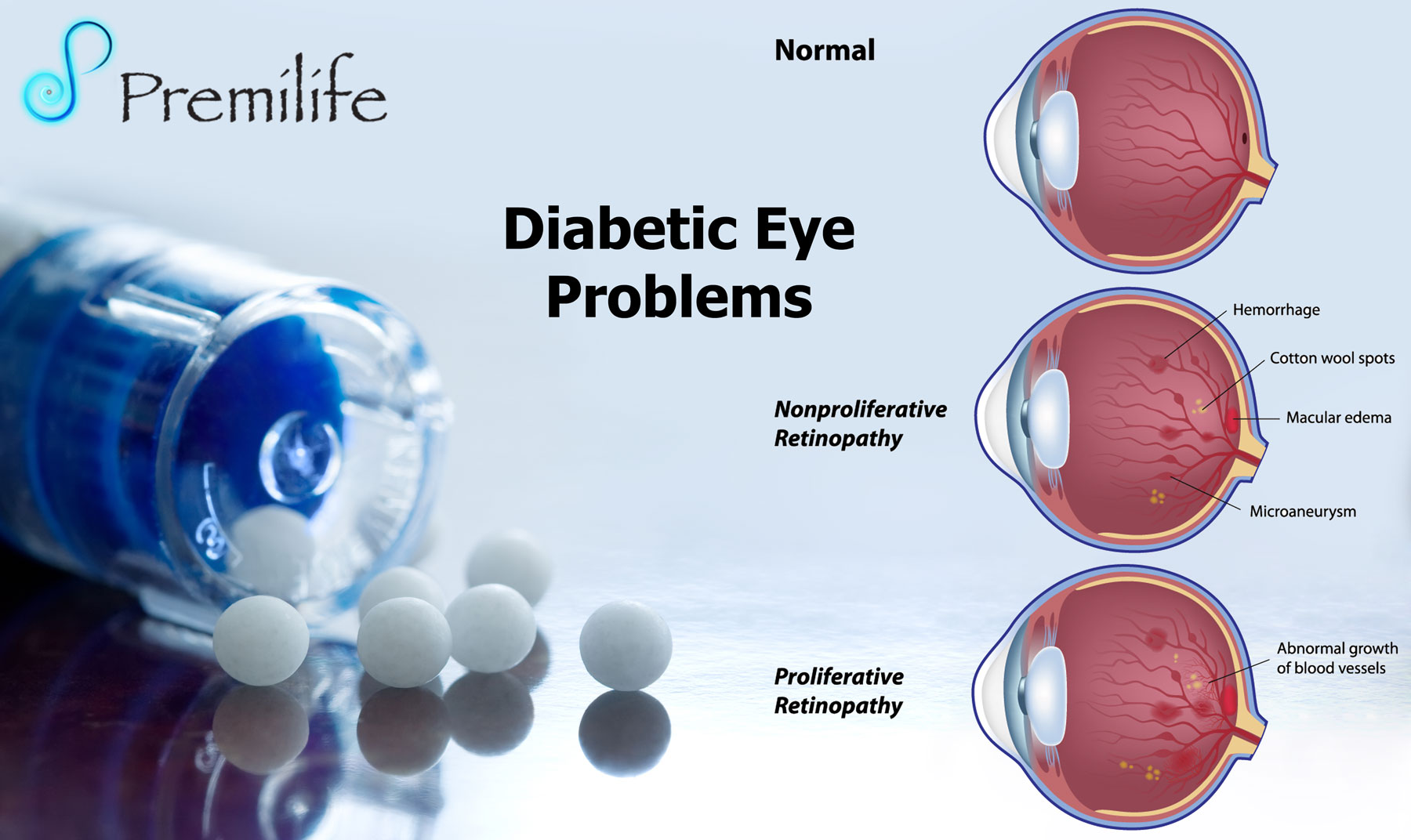 Diabetic Eye Problems | Premilife - Homeopathic Remedies