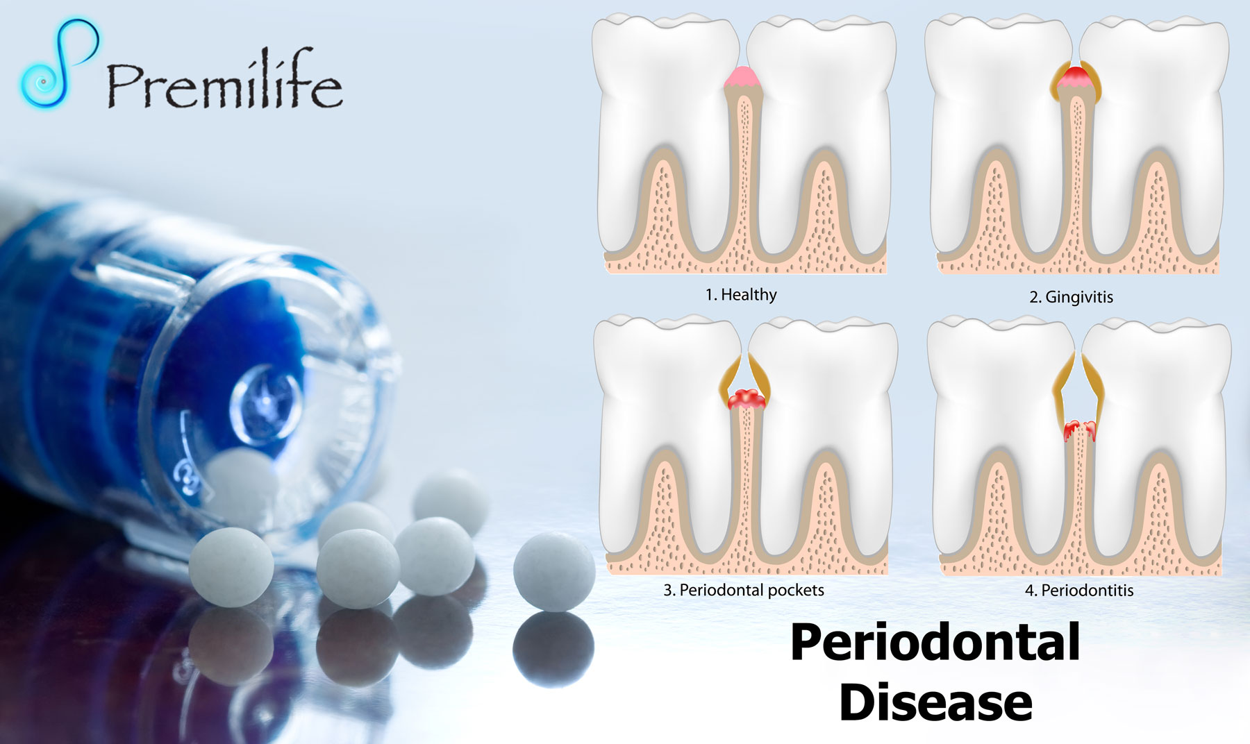 Periodontal Disease | Premilife - Homeopathic Remedies