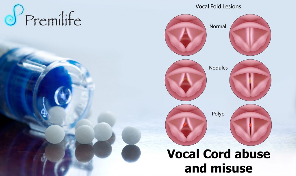 Vocal Cord Abuse and Misuse | Premilife - Homeopathic Remedies
