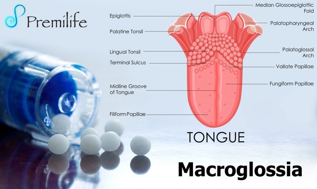 Macroglossia | Premilife - Homeopathic Remedies