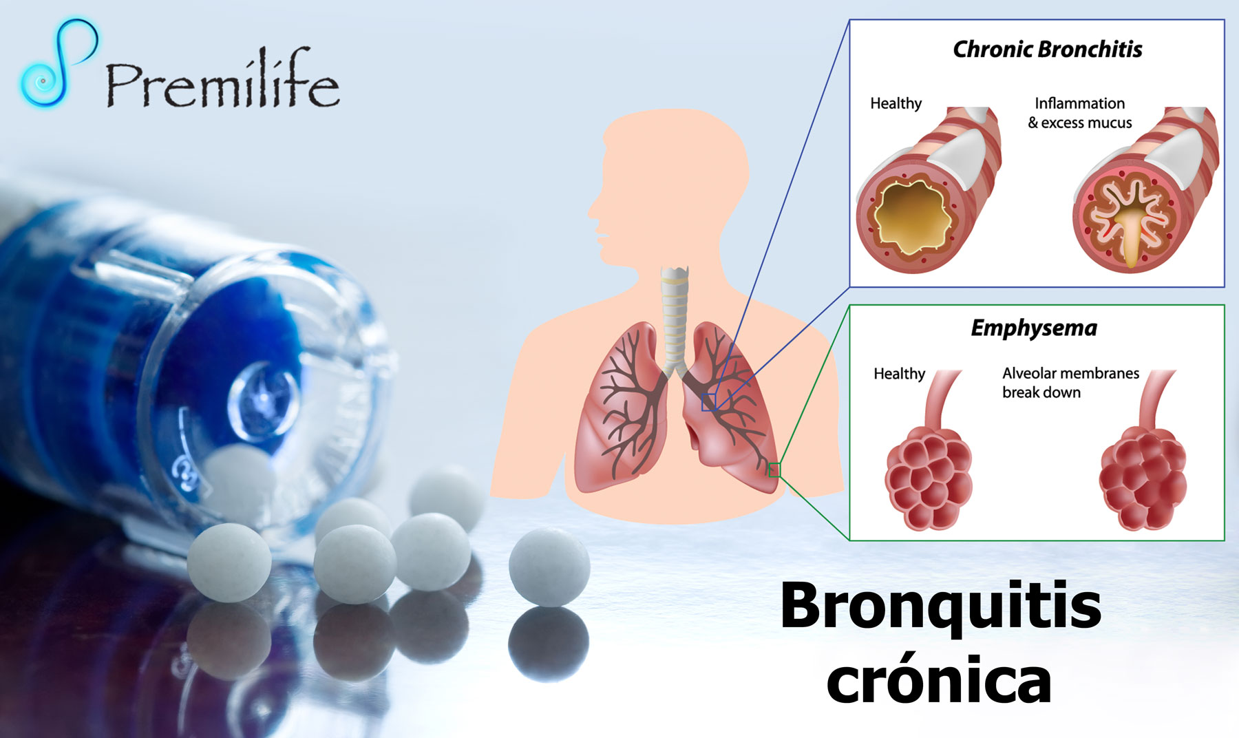 Bronquitis crónica | Premilife - Homeopathic Remedies