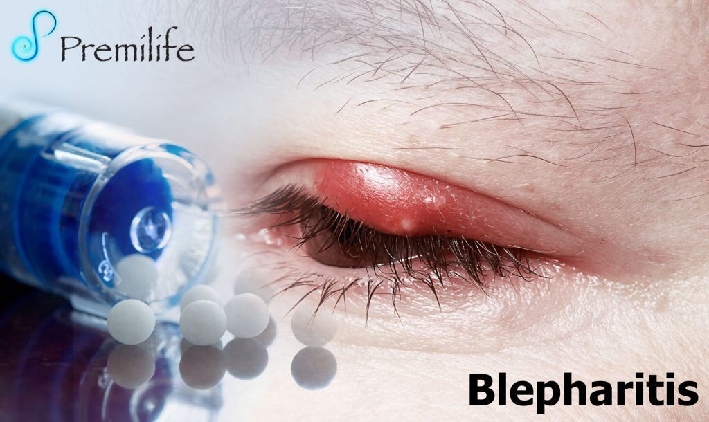 Blepharitis | Premilife - Homeopathic Remedies
