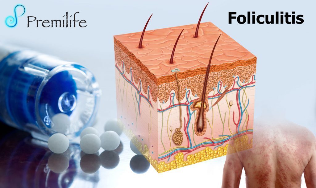 Foliculitis | Premilife - Homeopathic Remedies