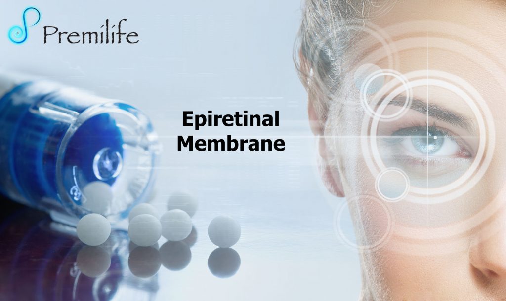 Epiretinal Membrane | Premilife - Homeopathic Remedies